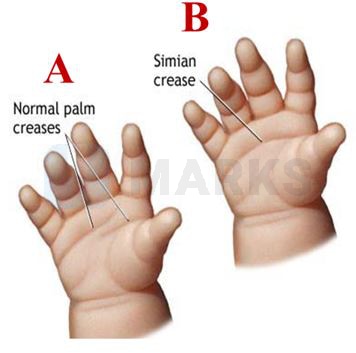 Child B is born with the palm as depicted in the figure below. Which ...